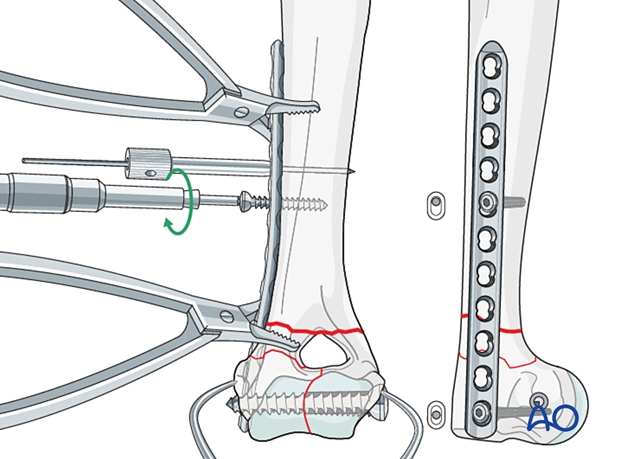 Transcondylar screw and bilateral plating for Simple complete articular ...