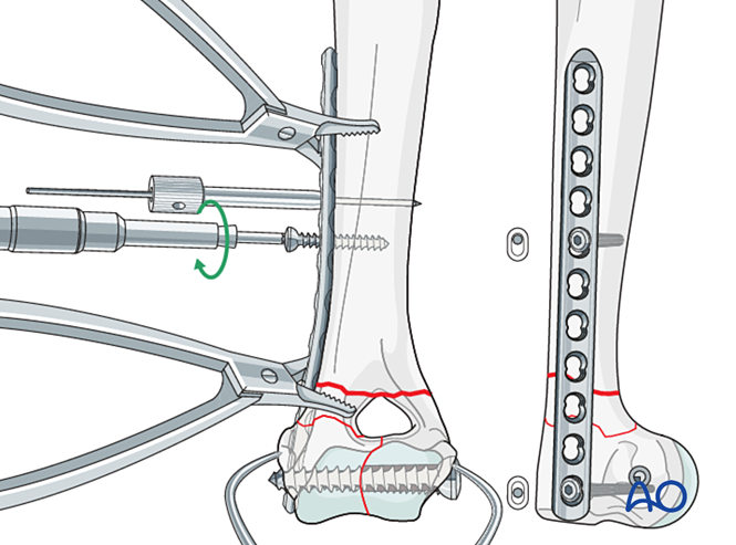 Transcondylar screw and bilateral plating for Simple complete articular ...