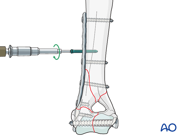 Transcondylar screw and bilateral plating for Simple complete articular ...