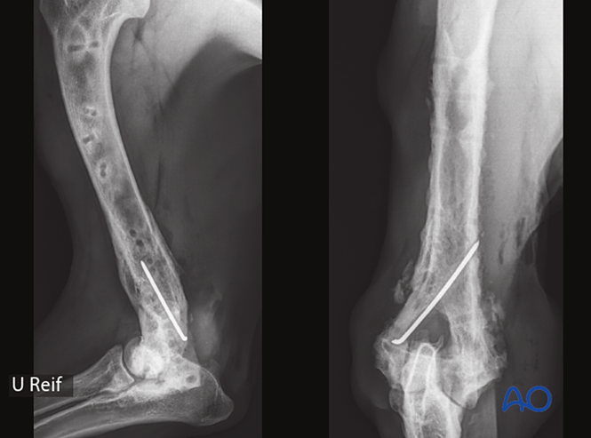 Transcondylar screw and bilateral plating for Simple complete articular ...