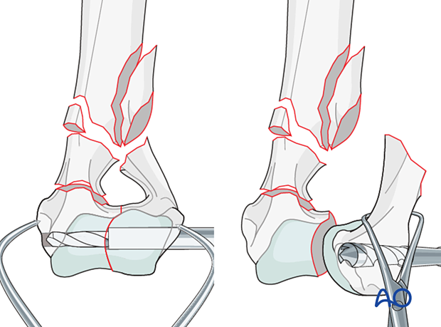 Transcondylar screw and hybrid circular external skeletal fixator for ...