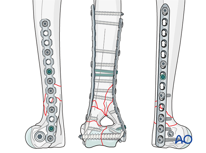 Transcondylar screw and bilateral plating for Simple complete articular ...