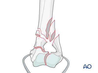 Transcondylar screw and hybrid circular external skeletal fixator for ...