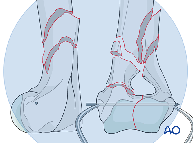 Transcondylar screw and hybrid circular external skeletal fixator for ...
