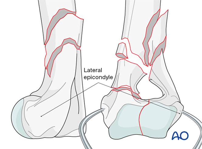 Transcondylar screw and hybrid circular external skeletal fixator for ...