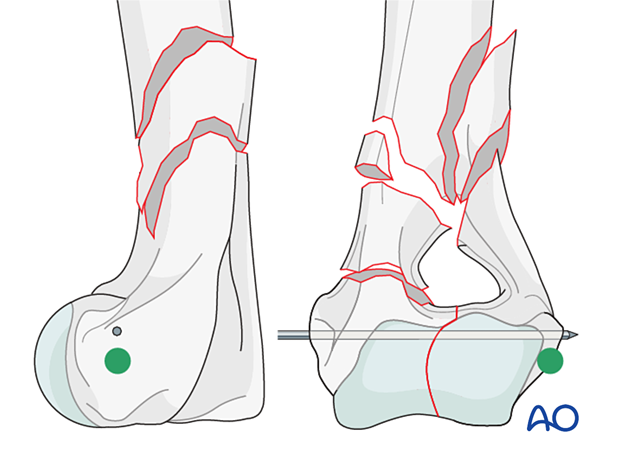 Transcondylar screw and hybrid circular external skeletal fixator for ...