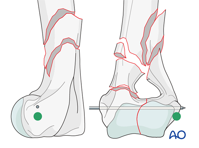 Transcondylar screw and hybrid circular external skeletal fixator for ...