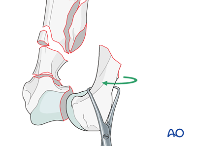 Transcondylar screw and hybrid circular external skeletal fixator for ...