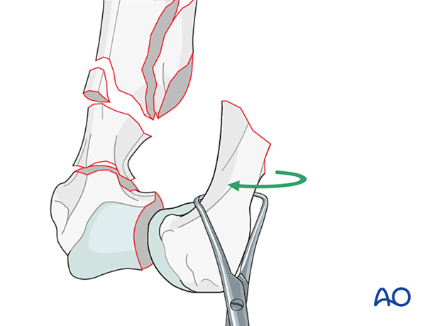 Transcondylar screw and hybrid circular external skeletal fixator for ...