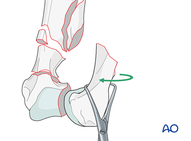 Transcondylar screw and hybrid circular external skeletal fixator for ...