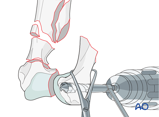 Transcondylar screw and hybrid circular external skeletal fixator for ...