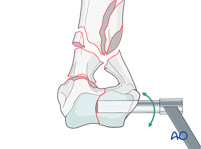 Transcondylar screw and hybrid circular external skeletal fixator for ...