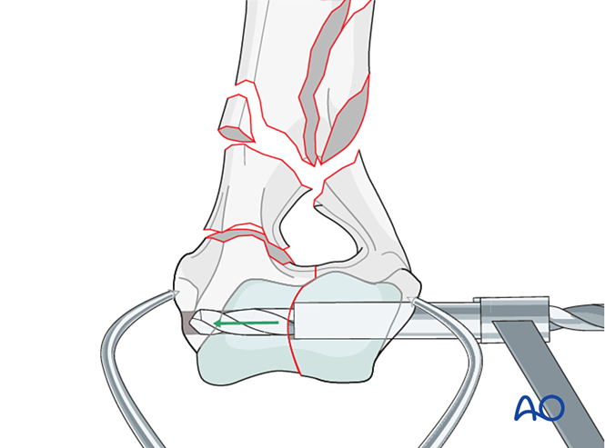 Transcondylar screw and hybrid circular external skeletal fixator for ...