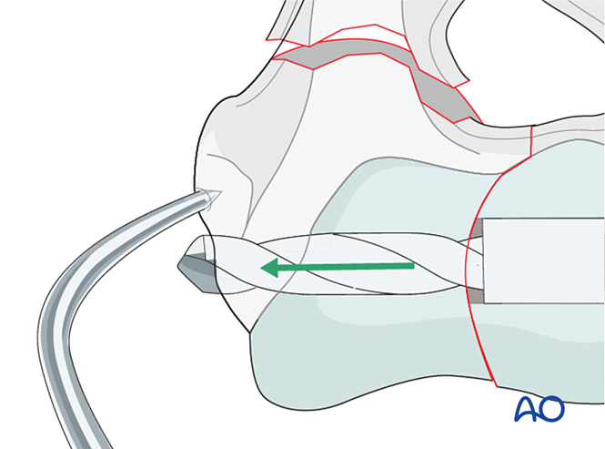 Transcondylar screw and hybrid circular external skeletal fixator for ...