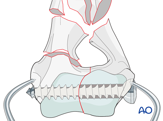 Transcondylar screw and hybrid circular external skeletal fixator for ...