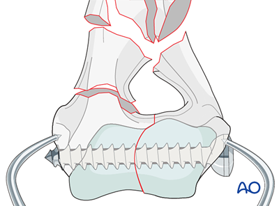 Transcondylar screw and hybrid circular external skeletal fixator for ...