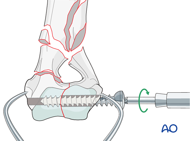 Transcondylar screw and hybrid circular external skeletal fixator for ...