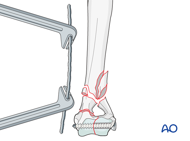 Transcondylar screw and bilateral plating for Simple complete articular ...