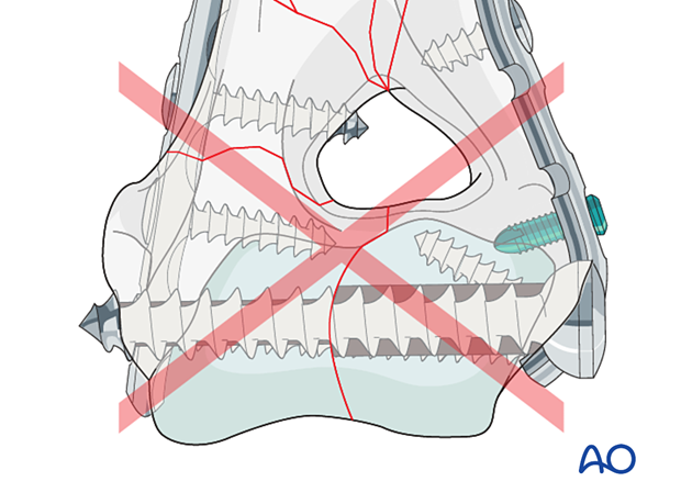 Transcondylar screw and bilateral plating for Simple complete articular ...