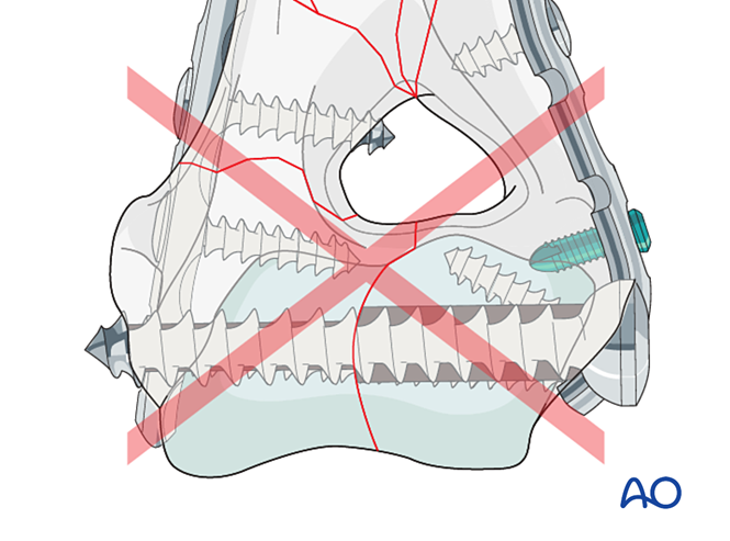 Transcondylar screw and bilateral plating for Simple complete articular ...