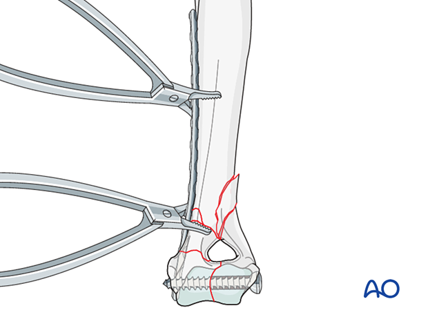 Transcondylar screw and bilateral plating for Simple complete articular ...