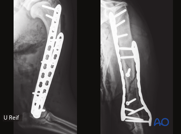 Transcondylar screw and bilateral plating for Simple complete articular ...