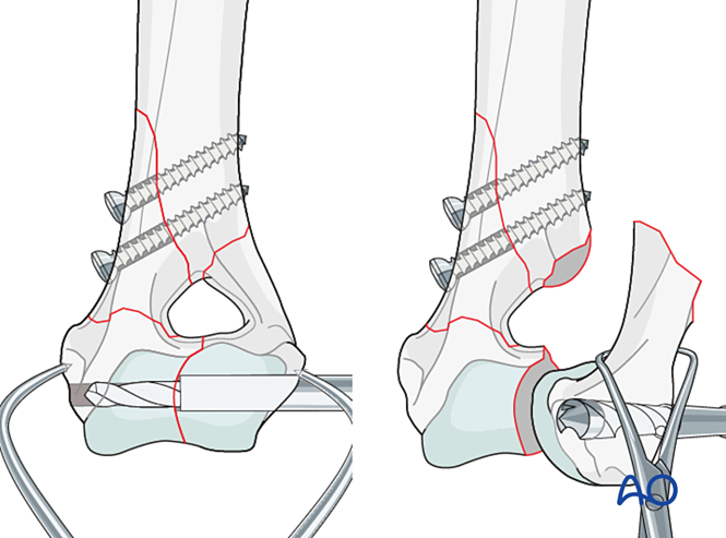 Transcondylar screw with buttress plate on wedge side and ...