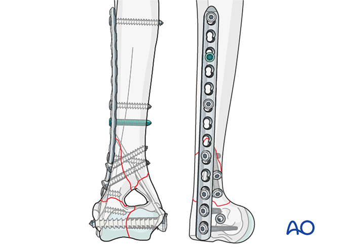 Transcondylar screw with buttress plate on wedge side and ...