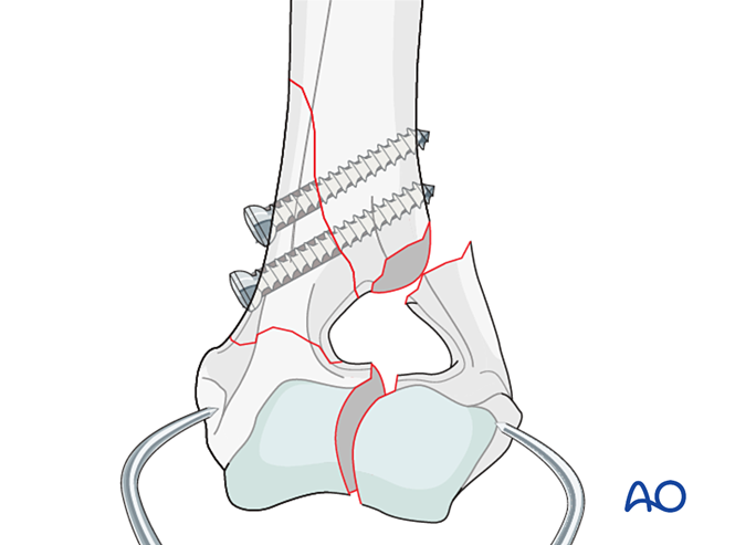 Transcondylar screw with buttress plate on wedge side and ...