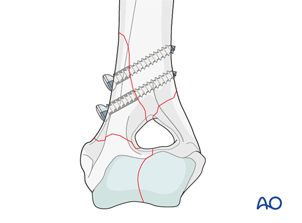 Transcondylar screw with buttress plate on wedge side and ...