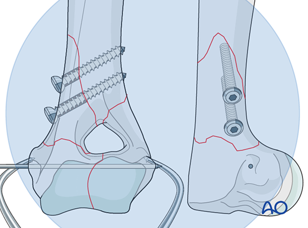 Transcondylar screw with buttress plate on wedge side and ...