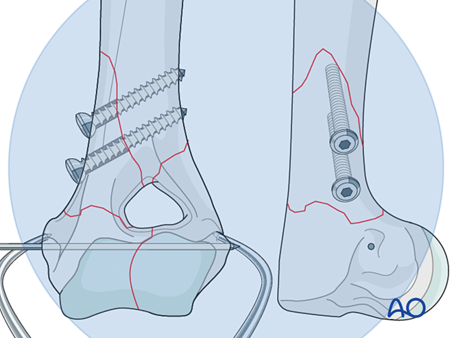 Transcondylar screw with buttress plate on wedge side and ...
