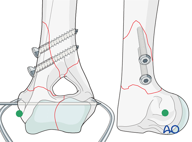 Transcondylar screw with buttress plate on wedge side and ...