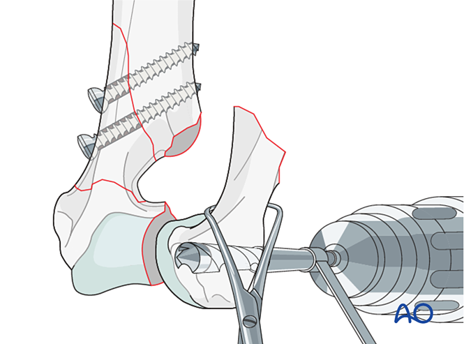 Transcondylar screw with buttress plate on wedge side and ...