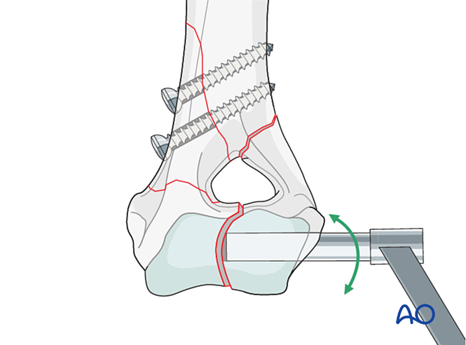 Transcondylar screw with buttress plate on wedge side and ...