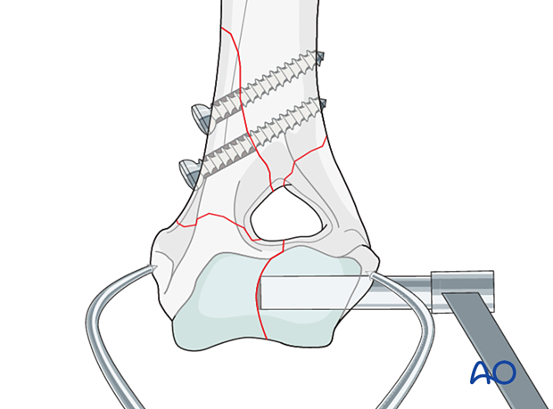 Transcondylar screw with buttress plate on wedge side and ...