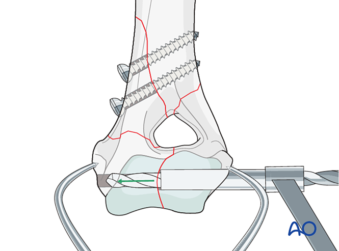 Transcondylar screw with buttress plate on wedge side and ...