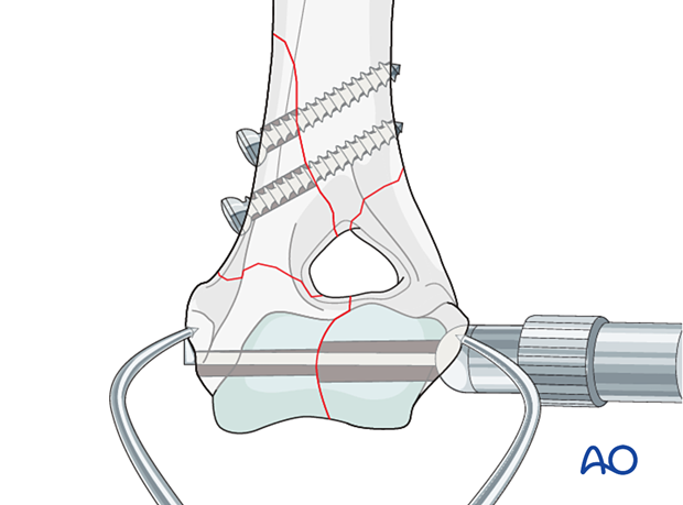 Transcondylar screw with buttress plate on wedge side and ...