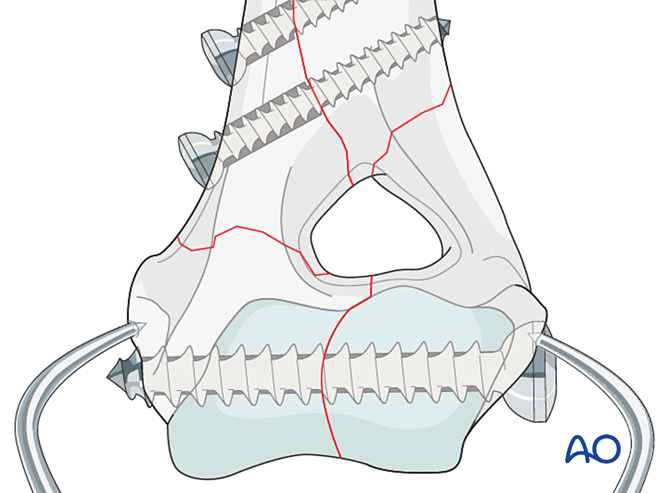 Transcondylar screw with buttress plate on wedge side and ...