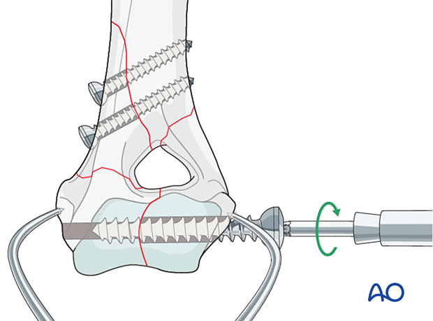 Transcondylar screw with buttress plate on wedge side and ...