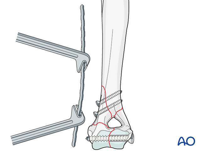 Transcondylar screw with buttress plate on wedge side and ...