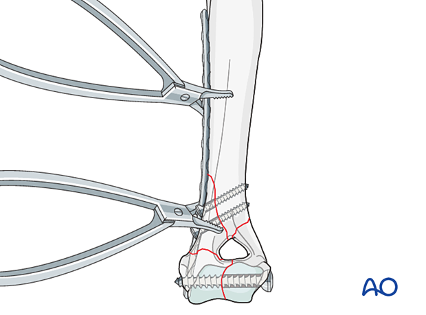 Transcondylar screw with buttress plate on wedge side and ...