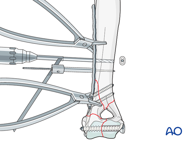 Transcondylar screw with buttress plate on wedge side and ...