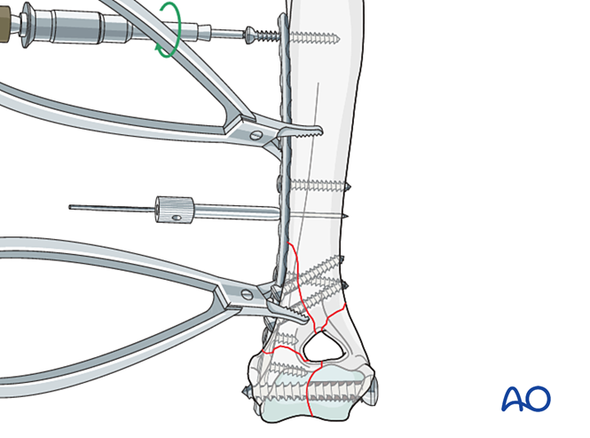 Transcondylar screw with buttress plate on wedge side and ...