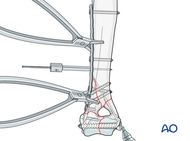 Transcondylar screw with buttress plate on wedge side and ...