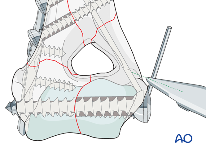 Transcondylar screw with buttress plate on wedge side and ...