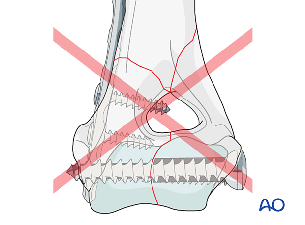 Transcondylar screw with unilateral plating and contralateral ...