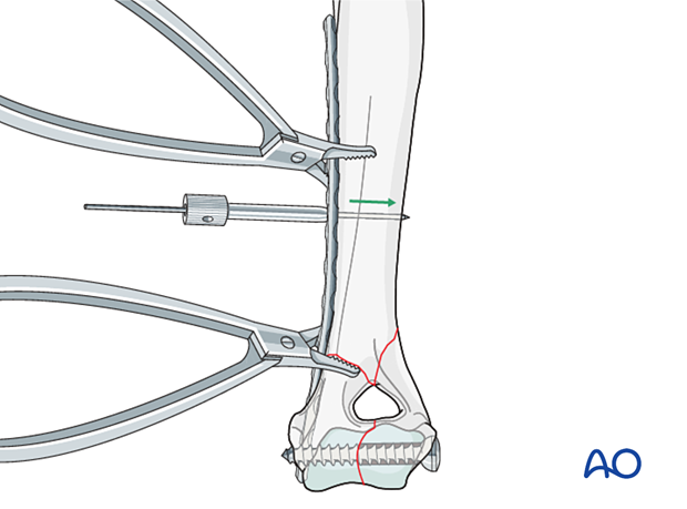 Transcondylar screw with unilateral plating and contralateral ...
