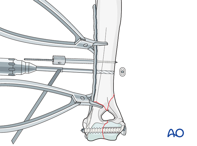 Transcondylar screw with unilateral plating and contralateral ...