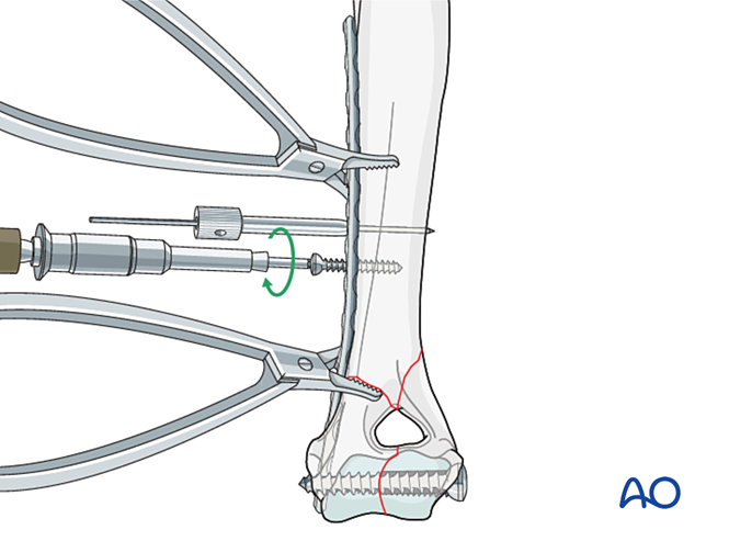 Transcondylar screw with unilateral plating and contralateral ...